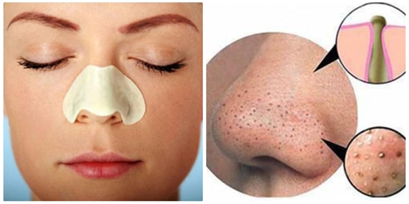 Blackheads : View from an expert dermatologist- Grace Skincare Clinic